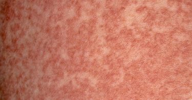 Ambrosia (Ragweed) Allergy: Symptoms and Treatment | Women's Alphabet