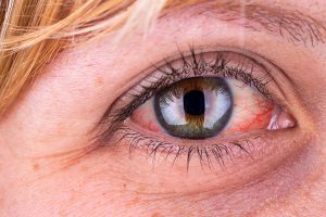 Red Eyes: Causes, Treatment and Tips | Women's Alphabet