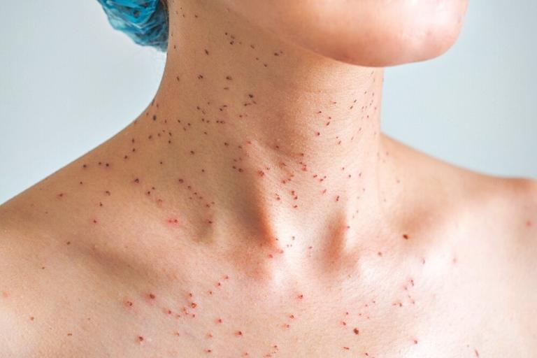 Red Spots on The Skin: 7 Possible Causes and Treatments | Women's Alphabet