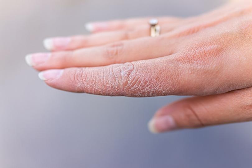 Dry & Cracked Hands: Causes and Treatment | Women's Alphabet Dry & Cracked Hands: Causes and Treatment | Women's Alphabet