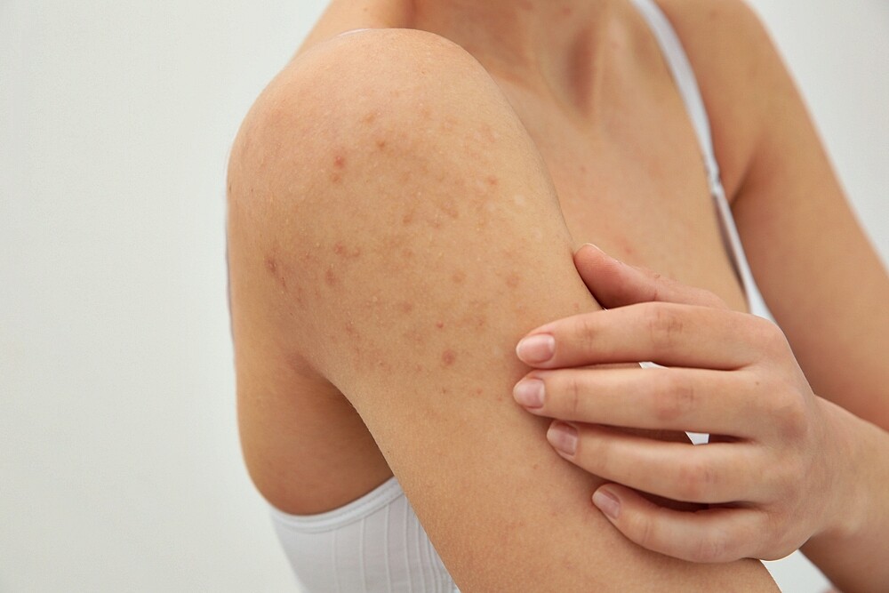 Pimples On The Upper Arm This Helps Pimples On The Upper Arm This Helps