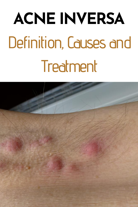 Acne Inversa (Hidradenitis Suppurativa): Definition, Causes and Treatment