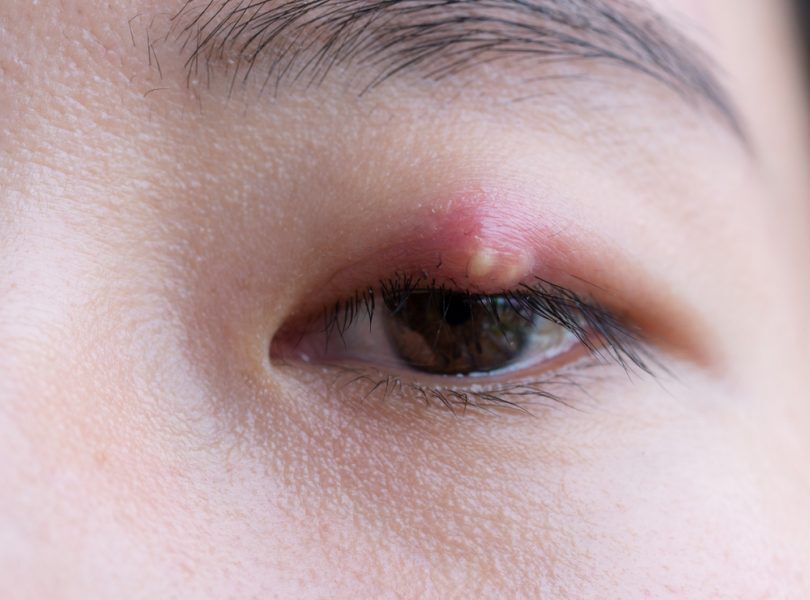 Everything You Need to Know About Styes | Women's Alphabet