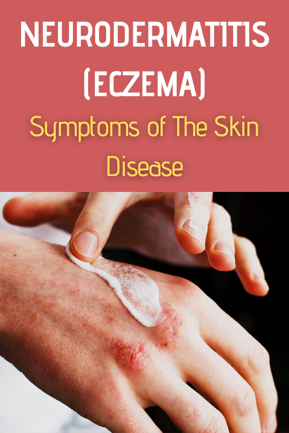 Neurodermatitis (Eczema): Symptoms of The Skin Disease