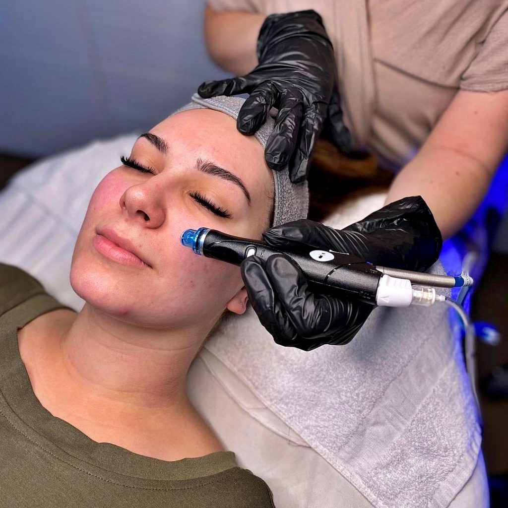 HydraFacial for Bright and Glowing Skin