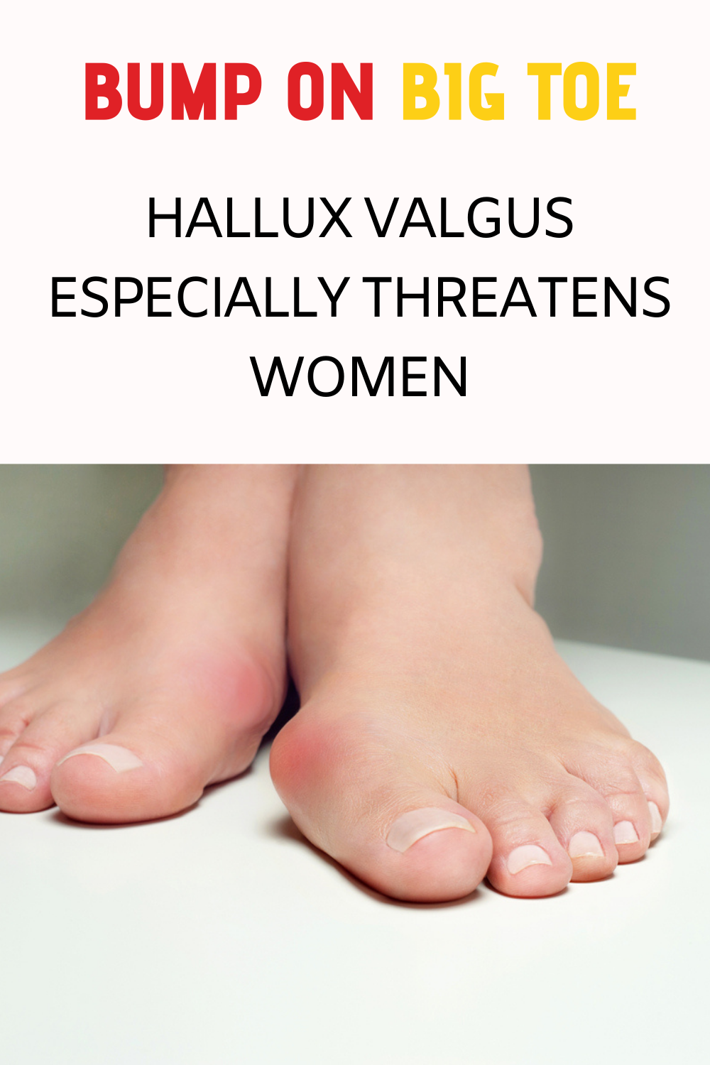 Bump On Big Toe Hallux Valgus Especially Threatens Women bump-on-big-toe-hallux-valgus-especially-threatens-women
