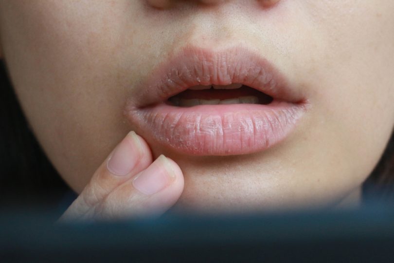 8 Natural Remedies to Get Rid of Cracked Lips | Women's Alphabet