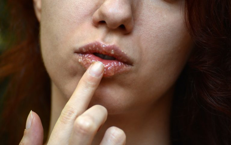 8 Natural Remedies to Get Rid of Cracked Lips | Women's Alphabet