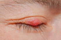 How to Get Rid of Puffy Eyes From Crying | Women's Alphabet